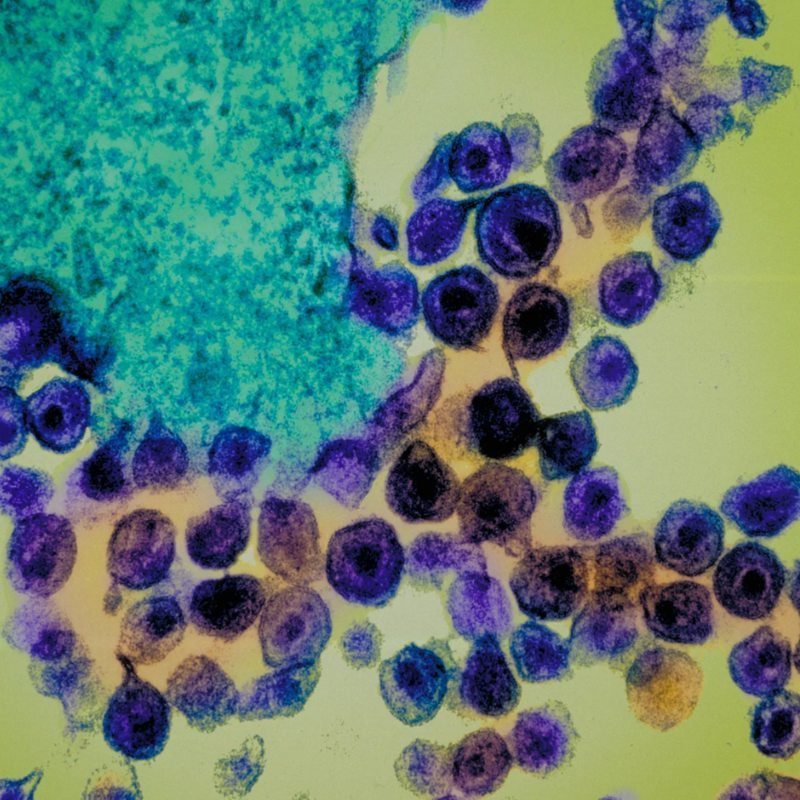 A Bold Effort To Cure HIV—Using Crispr - Ben Franklin Technology Partners