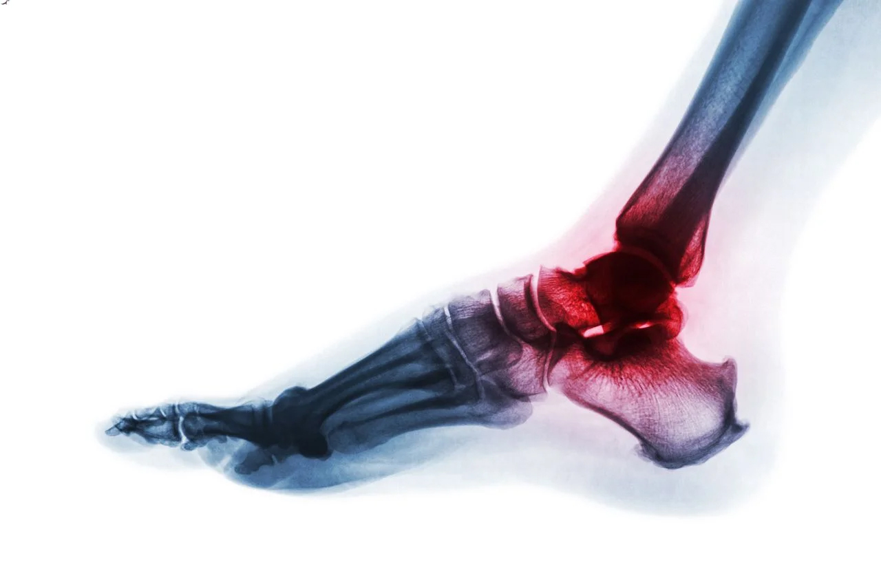 First All-Metal Patient-Specific Instrument In Ankle Arthroplasty - Ben ...